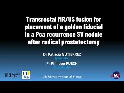 Fiducial in a seminal vesicle recurrence of PCa