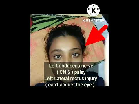 Left abducens nerve ( CN 6 ) palsy