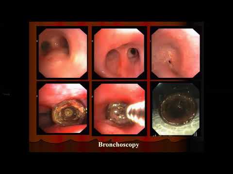 Bilateral Bronchieactasis