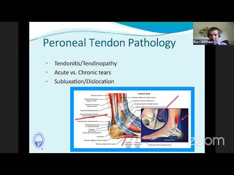 Peroneal Tendon Disorders