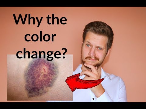 Why Do Bruises Change Color?