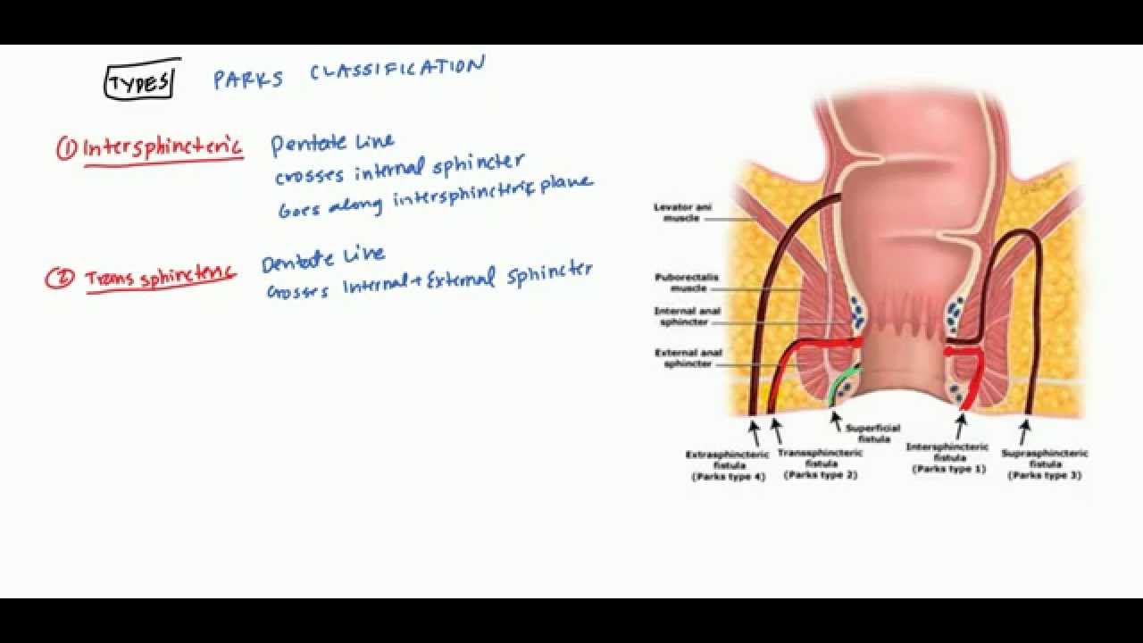 Anal Fistulas Lecture for USMLE Step 2