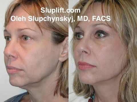 Facelift