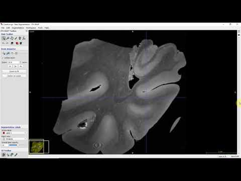 Overview of medial temporal lobe sulci