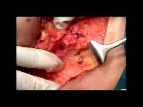 Sentinel Lymph Node Biopsy (SLNB)