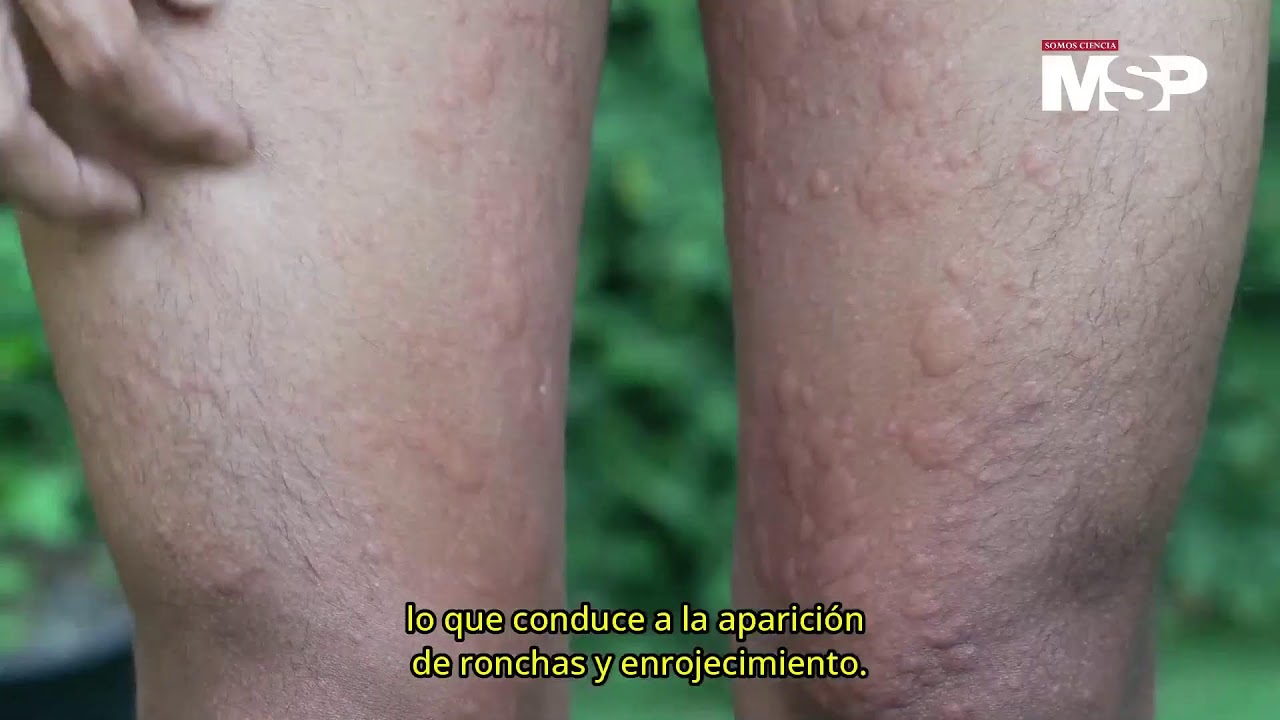 Día Mundial de la Urticaria: ¿Qué es y cómo funciona? - #ExclusivoMSP
