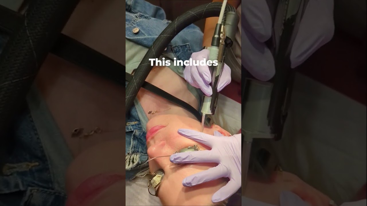 Cynergy Laser For Unsightly Broken Blood Vessels