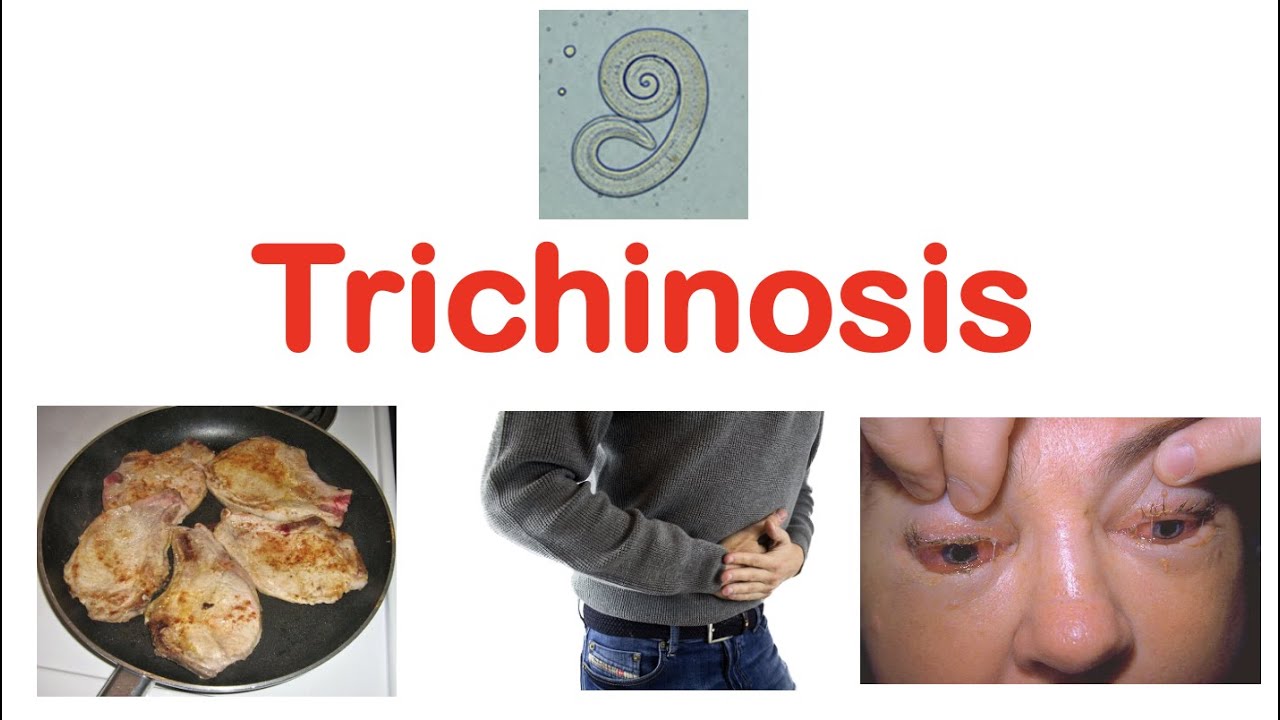 Trichinosis (Pork Parasite) | Pathophysiology, Signs & Symptoms, Diagnosis, Treatment