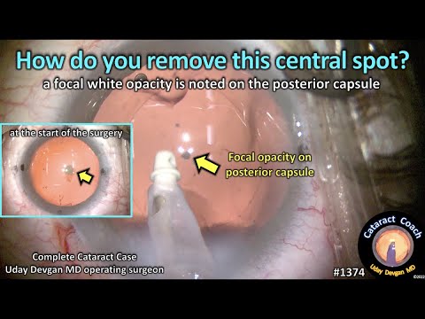 CataractCoach 1374: how do you remove this central spot on the capsule?