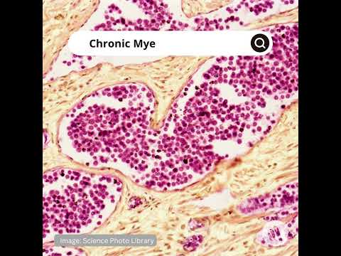 Chronic Myeloid Leukemia EN