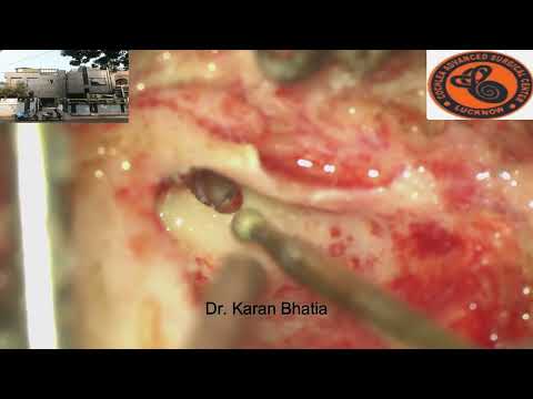 Cochlear implant (CI) surgery in an Enlarged Vestibular Aqueduct (EVA) patient.
