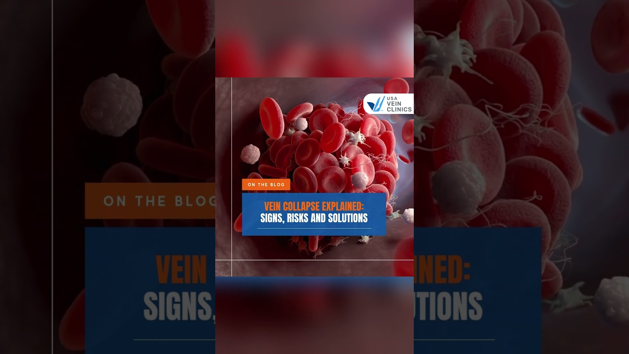 Vein Collapse Explained: Signs, Risks, and Solutions