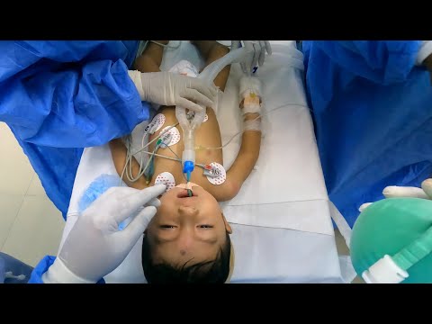 Pediatric Anesthesia Intubation Lessons - Anesthesiologist POV