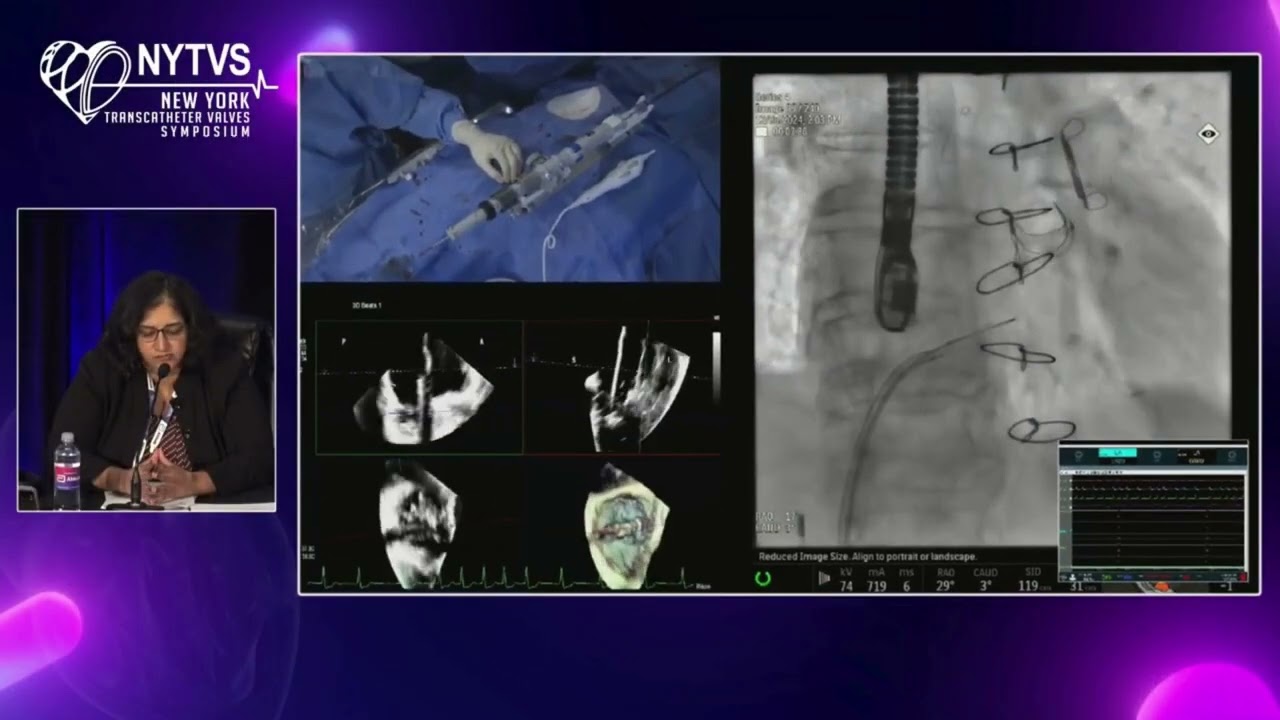 LIVE CASE 5 - Transcatheter Tricuspid Valve Replacement using Evoque