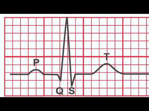 Normal EKG vs. Heart Attack