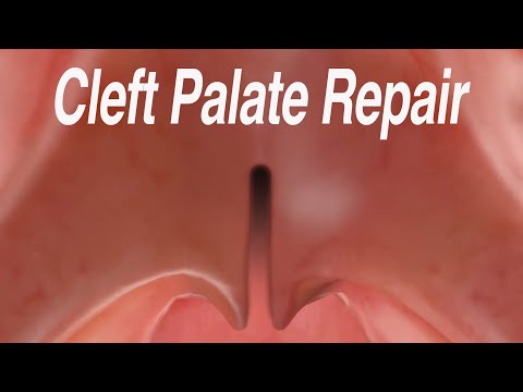 Cleft Palate Repair: Furlow Palatoplasty Technique