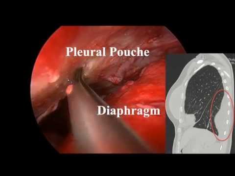 THORACOSCOPIC (VATS) DECORTICATION