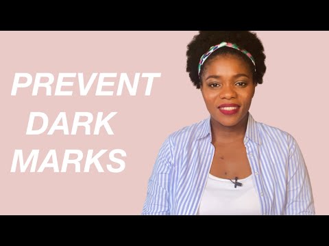 How to Prevent and Treat Post Inflammatory Hyperpigmentation on Dark Skin | Dr Janet