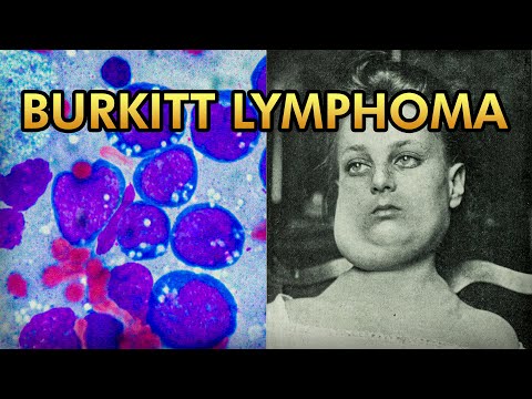 Burkitt's Lymphoma: Types, Signs and Symptoms, Pathophysiology, Diagnosis and Treatment