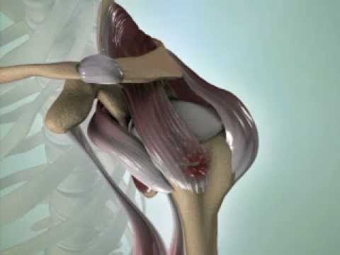 Torn Rotator Cuff Causes, Symptoms & Treatment - DePuy Videos