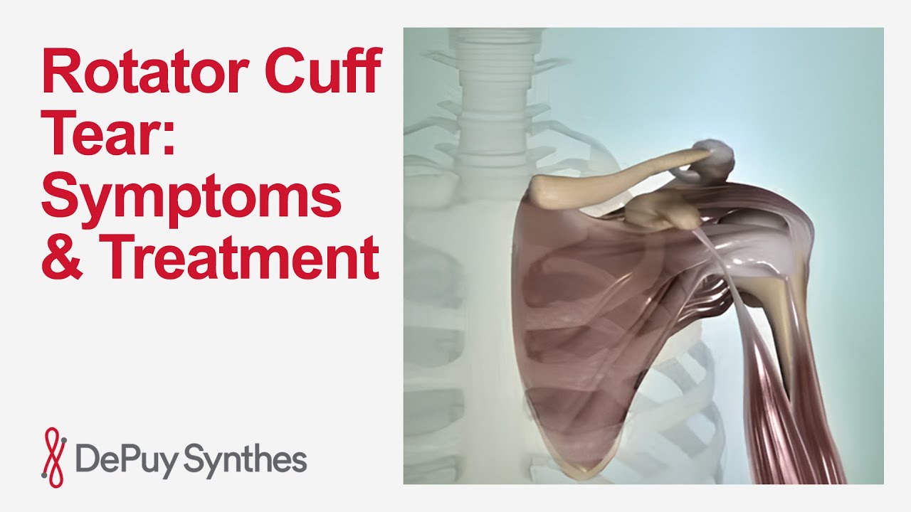 Torn Rotator Cuff: What You Need to Know About Causes, Symptoms and Treatment | DePuy Synthes