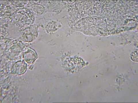Gynecology Vagina Mobiluncus