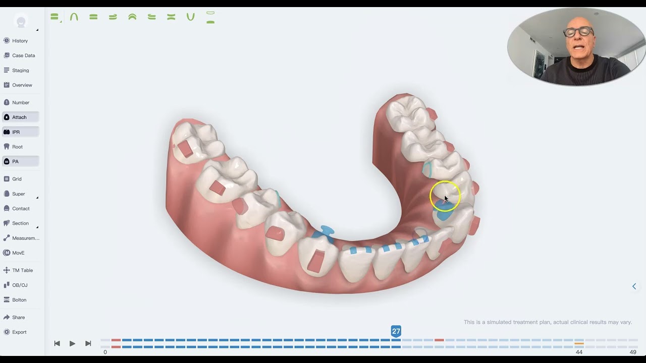 Angel Aligner iOrtho Tips
