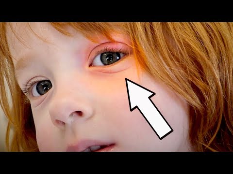 IS THIS PERIORBITAL CELLULITIS? | Dr. Paul
