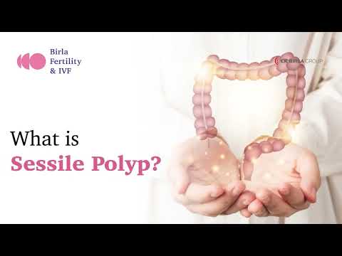 What is Sessile Polyp | Birla Fertility & IVF