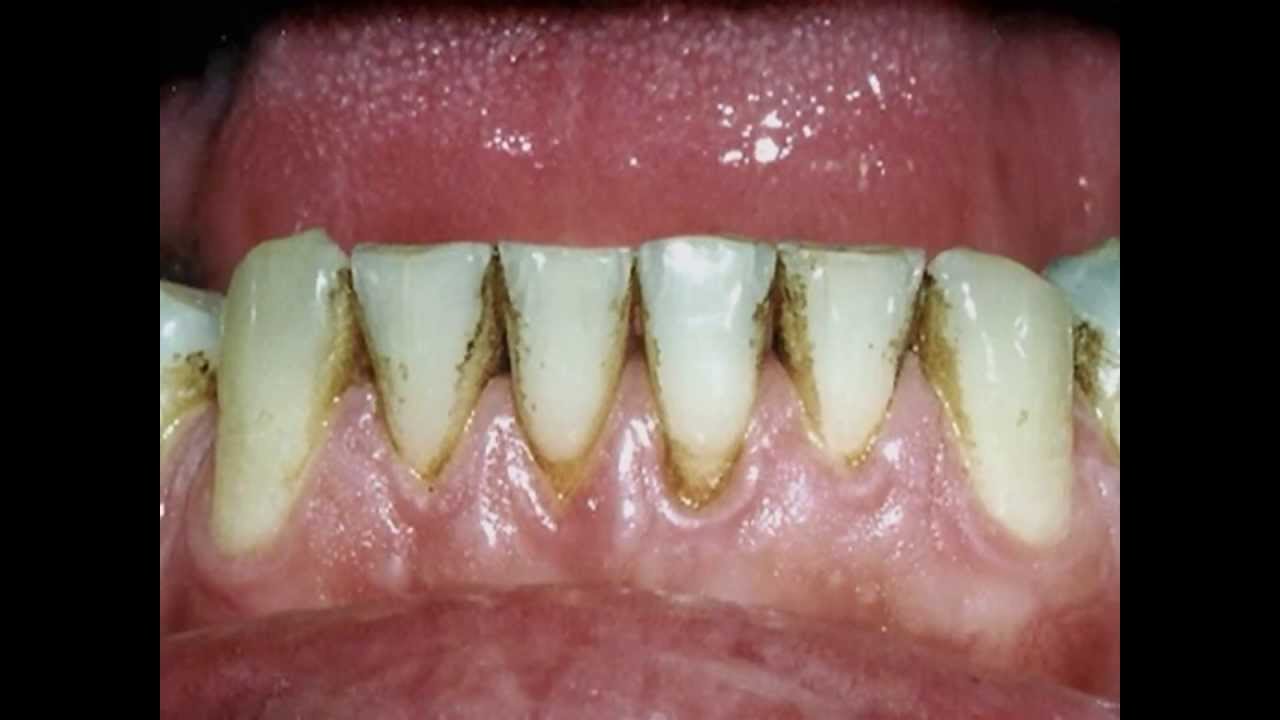 Smoking and Periodontal Disease | Lake Merritt Dental, Oakland, CA