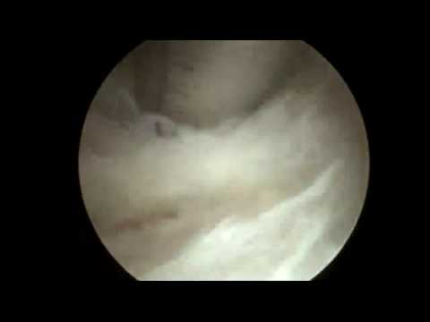 Olecranon Bursitis Inflamed Elbow Endoscopic Olecranon Bursa Excision at Elbow Cyfair Cypress TX