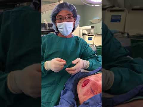 Dr. Gilbert Lee Explains Tissue Expanders for Breast Reconstruction