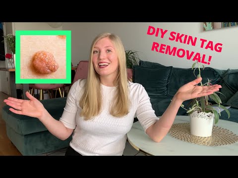 DIY Skin Tag Remover REVIEW!