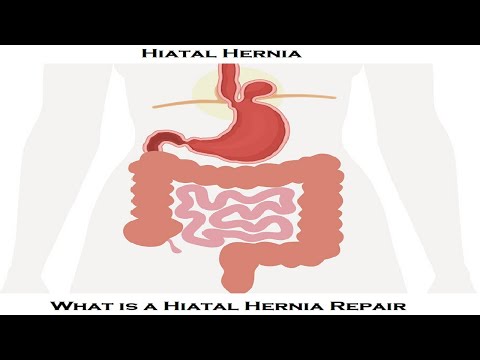 What is a Hiatal Hernia Repair A Hiatal Hernia Happens | Dr Technology