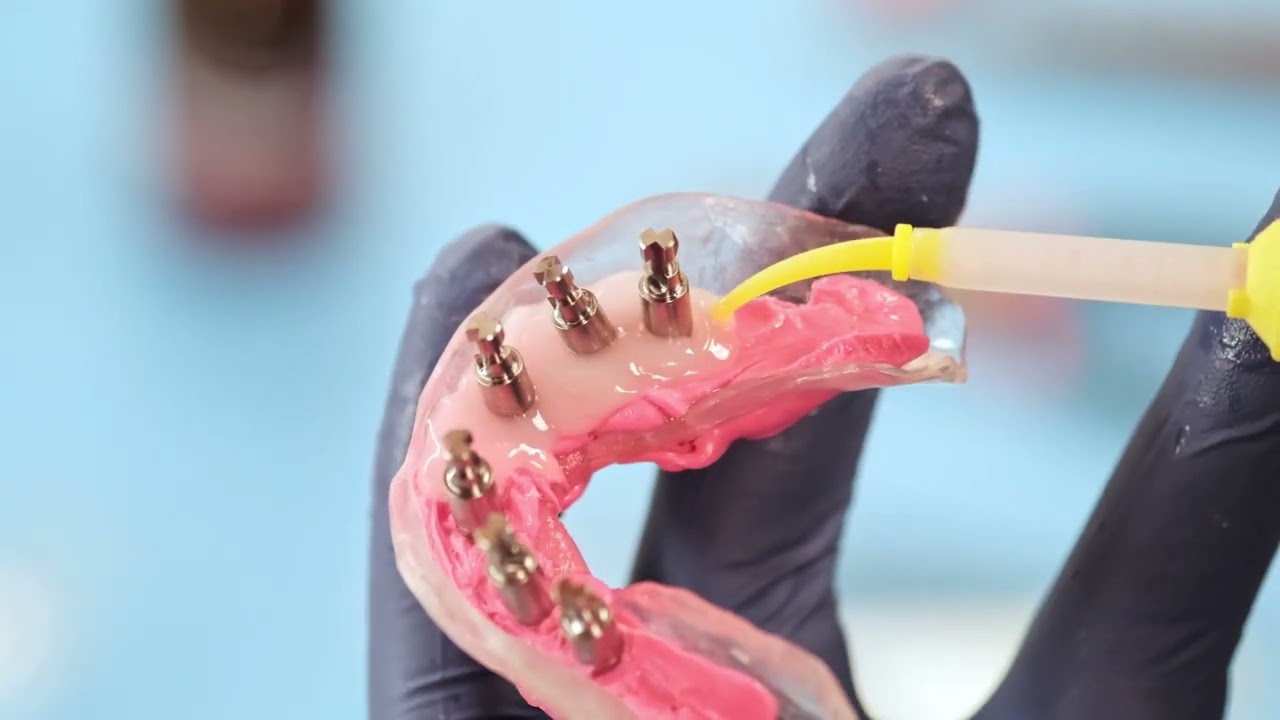 7 Questions to Ask Before Dental Implants!