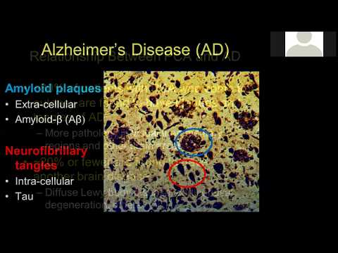 Posterior Cortical Atrophy | Memory and Aging Center