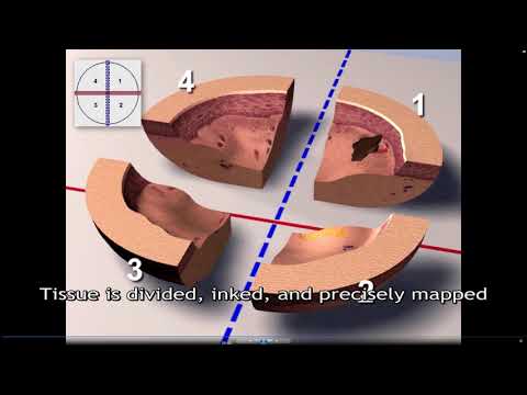 What is Mohs Surgery? by Mohs Surgeon and Dermatologist Dr. Tri Nguyen Texas Surgical Dermatology
