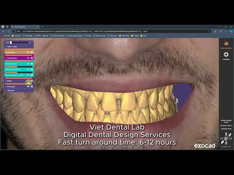 Digital Smile Design | Diagnostic Wax-Up Exocad Expert Viet Dental Lab