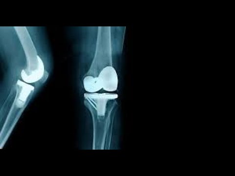 Arthroplasty Knee CPT code - simplify medical coding