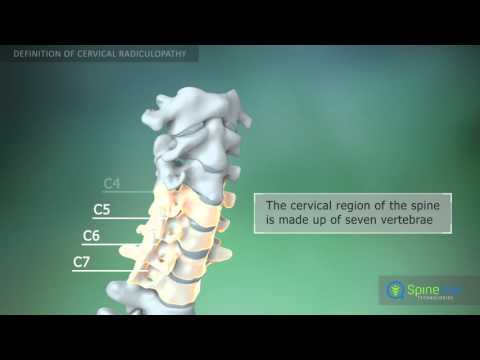 Cervical radiculopathy. Definition