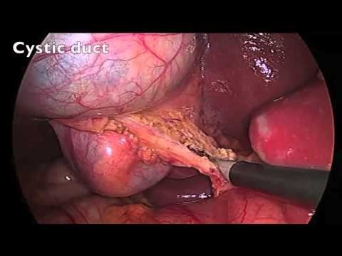Reduced Port cholecystectomy with LiVac Retractor