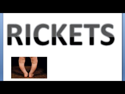 Pediatrics 125 Rickets Rachitic Rosary Vitamin D deficiency child Nutritional Refractory VDDR ALP
