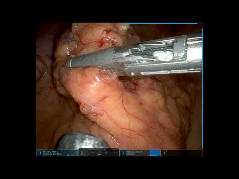 Robotic resection of Perigastric Metastasis from HLRCC