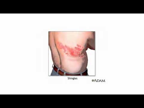 Pictures Of Shingles