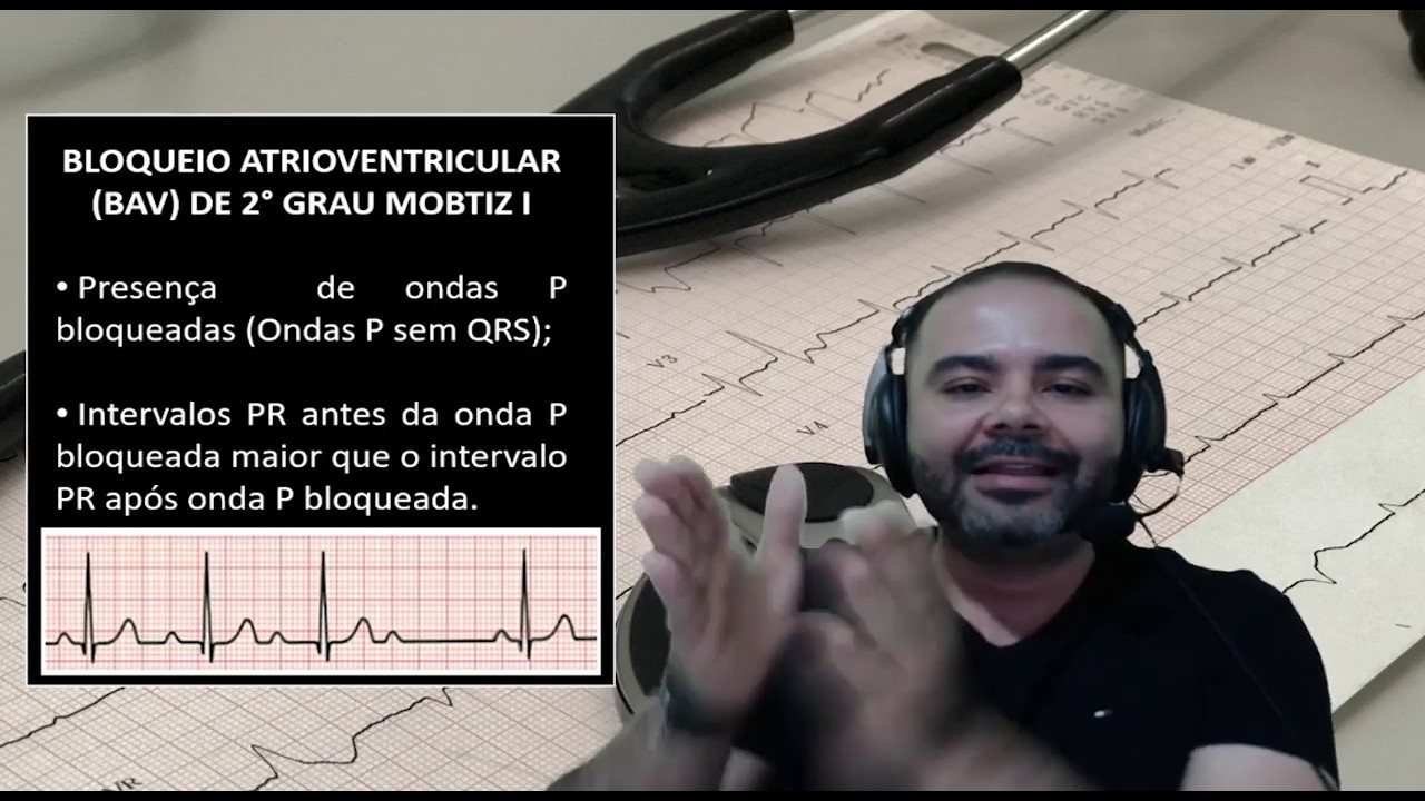 Bloqueio Atrioventricular (BAV) de 2° Grau Mobitz I