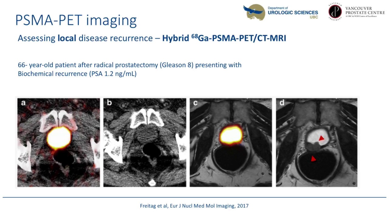 Prostate specific membrane antigen (PSMA) ligands for diagnosis and therapy of prostate cancer