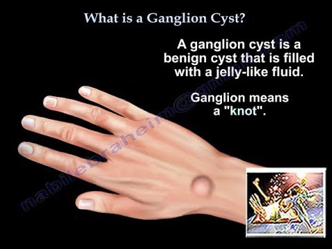 What is a Ganglion Cyst? – Dr. Nabil Ebraheim's Blog