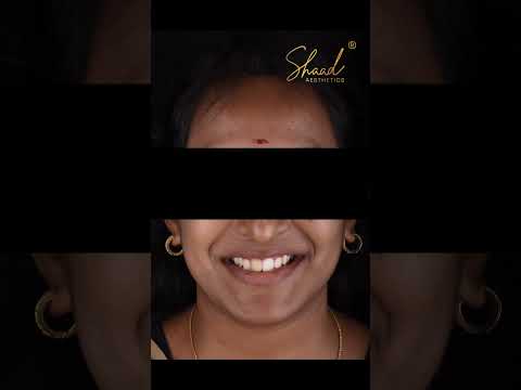 Smile Correction|Smile Design|Shaad Aesthetics|Dr Arshad|Cosmetic Dentistry|Tooth discoloration