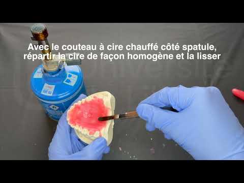 Plaque base maxillaire en Prothèse Amovible