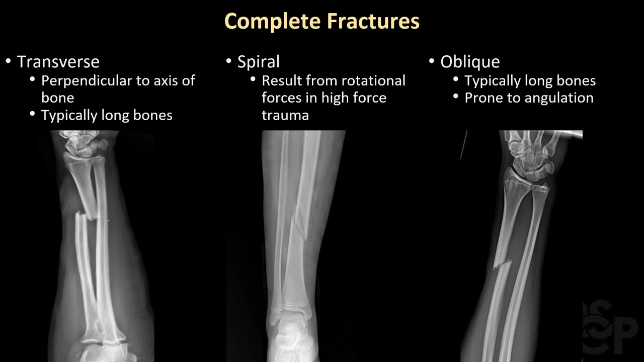 Fracture types - Radiology Education